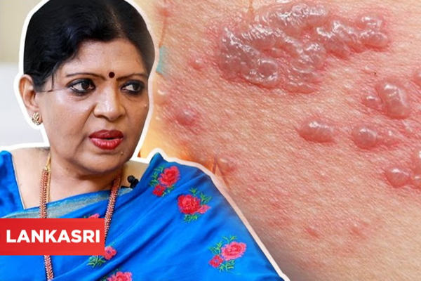 பெண் உறுப்பில் ஏற்படும் Rashes-க்கு என்ன தீர்வு? மருத்துவர் கூறும் ...