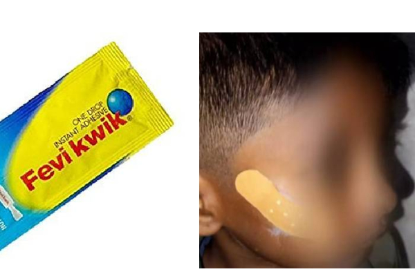 தையல்களுக்குப் பதிலாக Feviquick..செவிலியர் செய்த செயல் - கடைசியில் ...