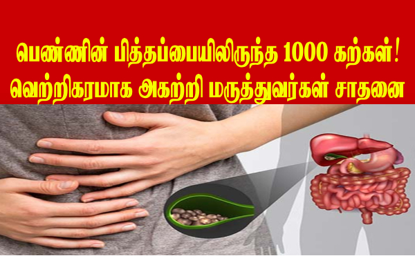 பெண்ணின் பித்தப்பையிலிருந்த 1000 கற்கள்! வெற்றிகரமாக அகற்றி ...