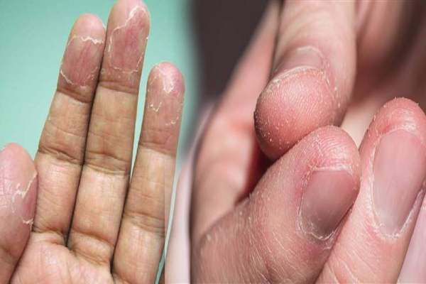 Skin Care:கைகளில் தோல் உரிய என்ன காரணம்? தடுக்கும் வழிமுறைகள் இதோ - மனிதன்